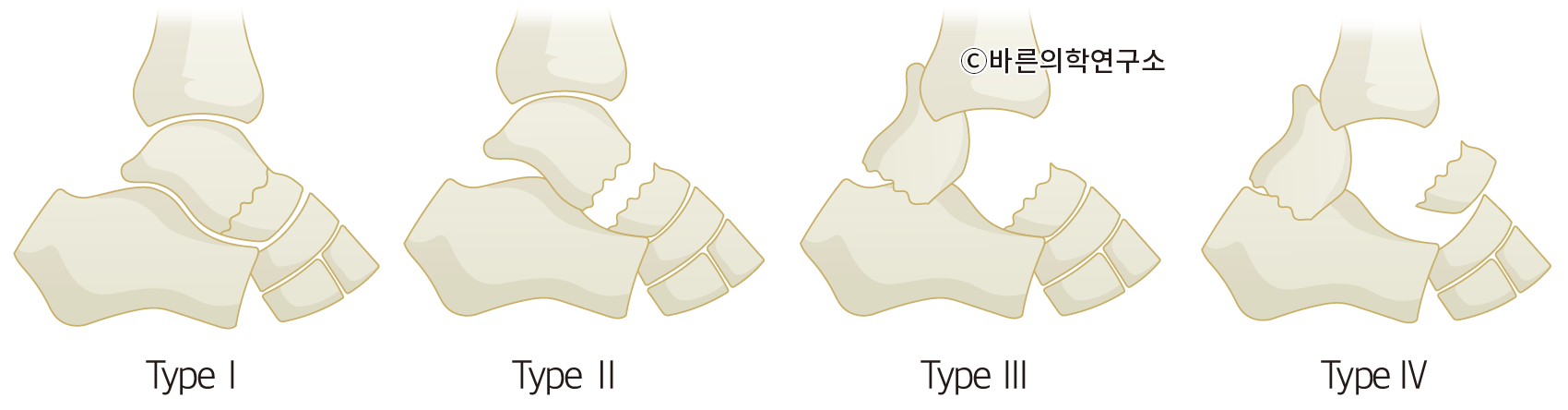 거골 골절(Fracture of the Talus) - Metamedic