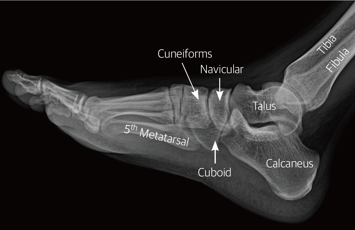 종골 골절(Fracture of the Calcaneus) - Metamedic