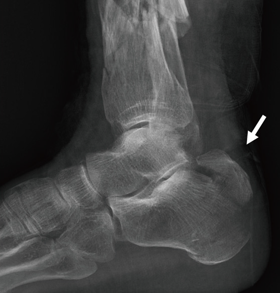 종골 골절(Fracture of the Calcaneus) - Metamedic