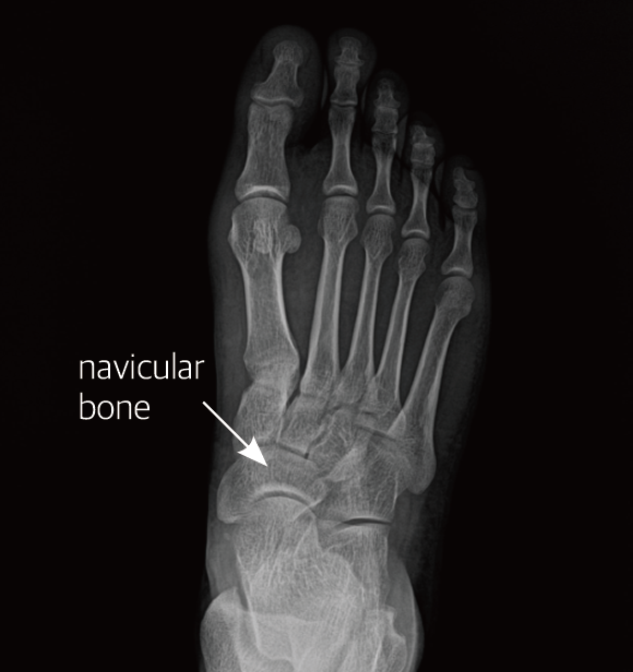 주상골/설상골/입방골 골절(Fracture of Navicula, Cuneiform or Cuboid) - Metamedic