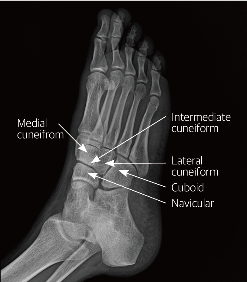 주상골/설상골/입방골 골절(Fracture of Navicula, Cuneiform or Cuboid) - Metamedic