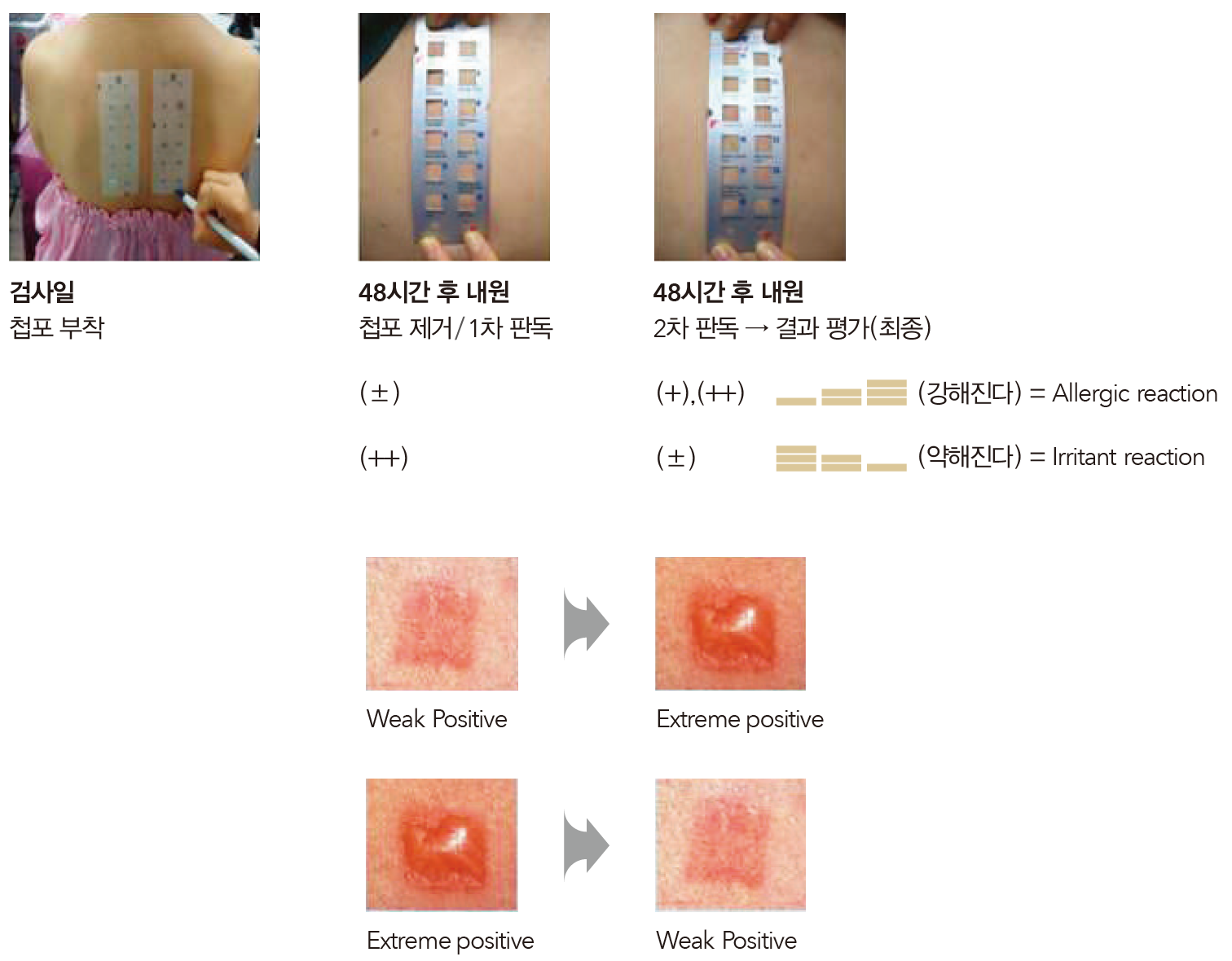접촉피부염(Contact dermatitis) - Metamedic