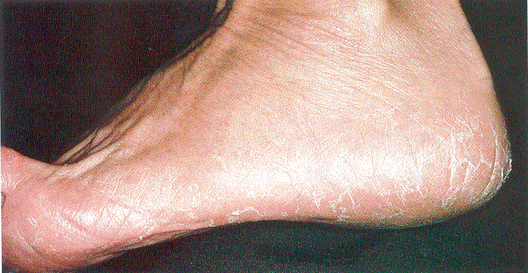 백선/손발톱진균증 (Dermatophytosis/Onychomychosis) - Metamedic