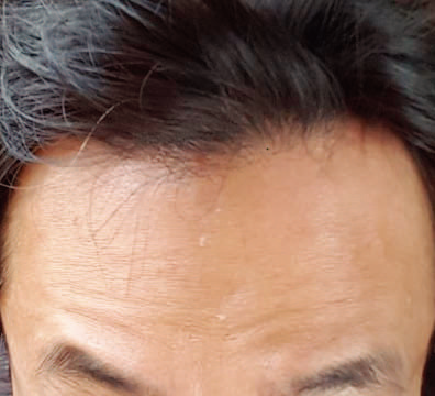 탈모(Alopecia) - Metamedic