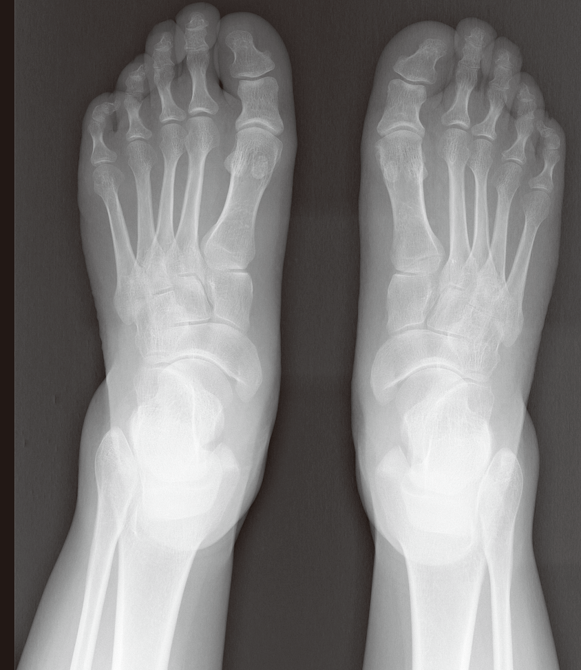 류마티스 관절염 (Rheumatoid Arthritis, RA) - Metamedic