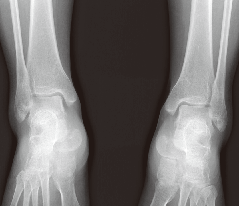 류마티스 관절염 (Rheumatoid Arthritis, RA) - Metamedic