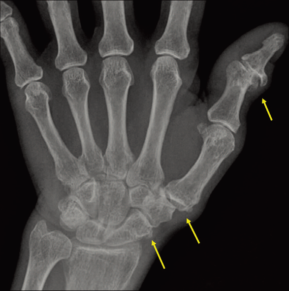 골관절염(Osteoarthritis, OA) - Metamedic