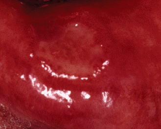 흔한 구강 질환(Common oral lesions) - Metamedic