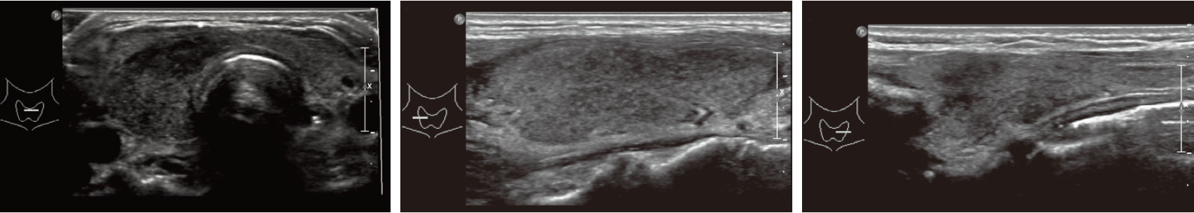 갑상샘염(Thyroiditis) - Metamedic
