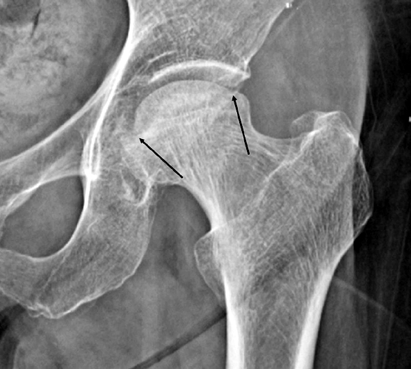 고관절 통증(Hip pain) - Metamedic