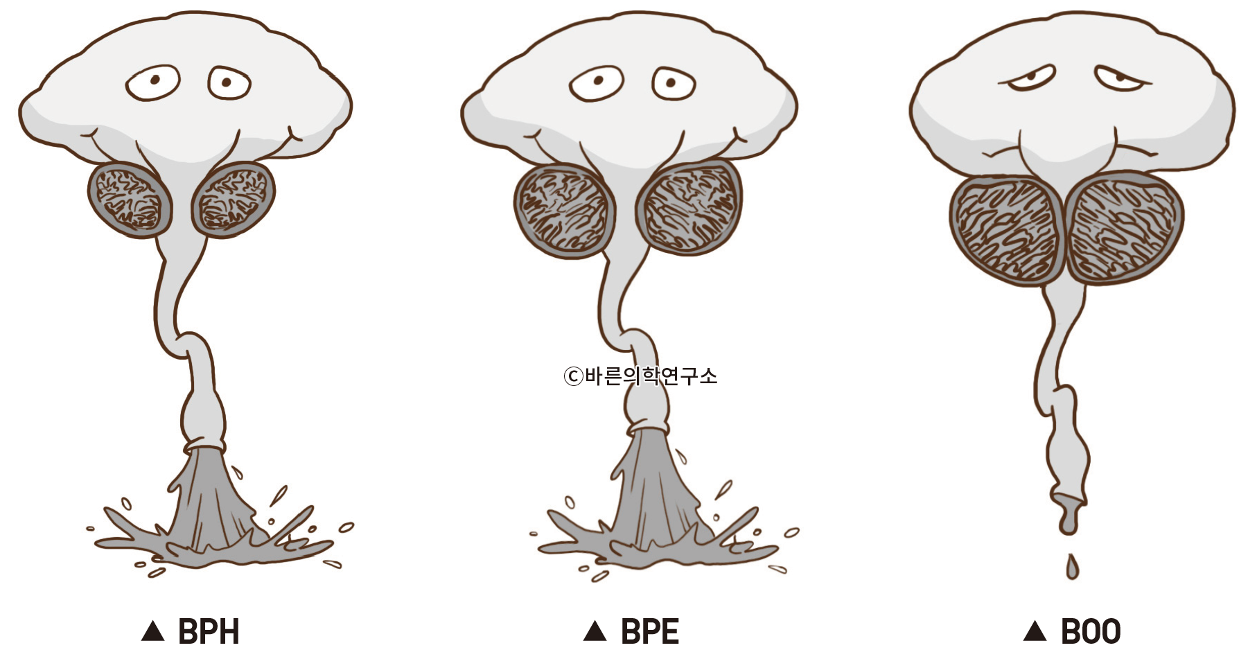 하부요로증상(Lower urinary tract symptoms) - Metamedic