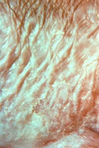 외음부 피부병변(Vulvar dermatoses) - Metamedic