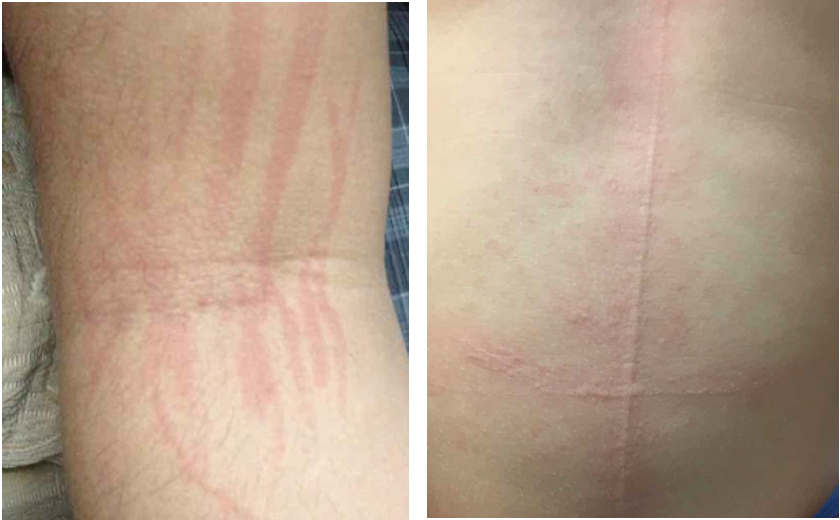 두드러기/혈관부종(Urticaria/Angioedema) - Metamedic