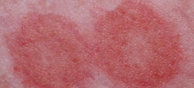 원형/과녁모양 병변(Annular/Targetoid lesions) - Metamedic