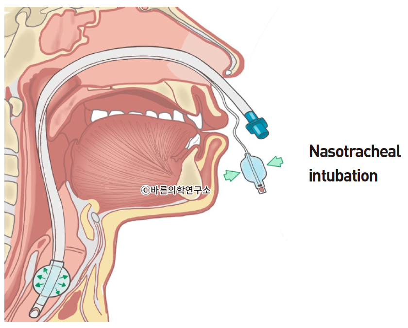 침습적 기도 환기/관리: 기관 삽관 - Metamedic