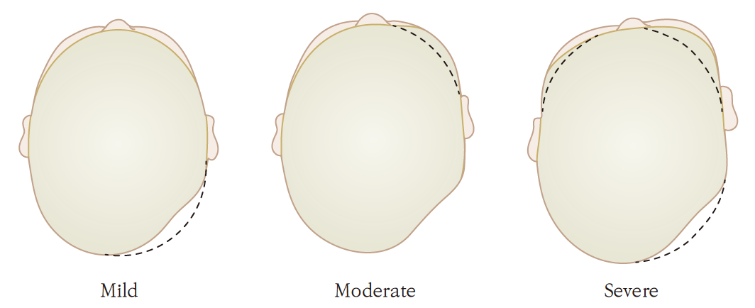 머리 모양 이상(Abnormal head shape) - Metamedic