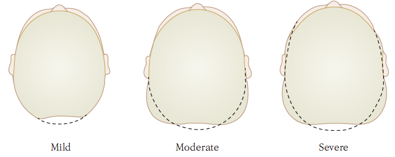 머리 모양 이상(Abnormal head shape) - Metamedic