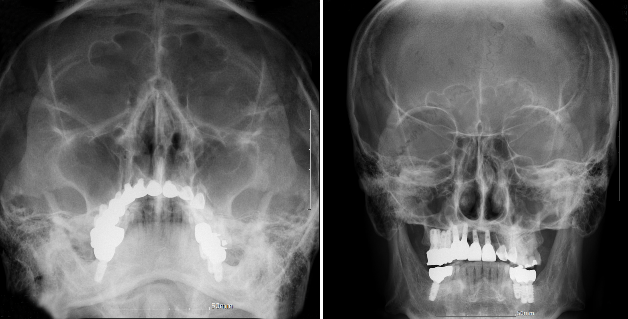 [실전증례] 급성 비부비동염(Acute rhinosinusitis) - Metamedic