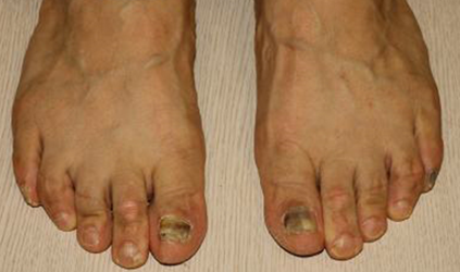 [실전진료] 백선/손발톱진균증(Tinea infection/Onychomycosis) - Metamedic