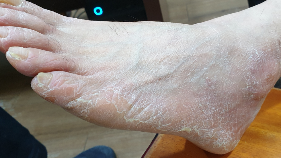 [실전증례(1)] 백선/손발톱진균증(Tinea infection/Onychomycosis) - Metamedic