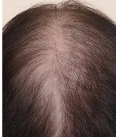 [실전증례] 탈모(Alopecia) - Metamedic