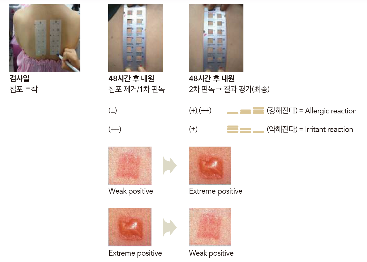 [실전진료] 접촉피부염(Contact dermatitis) - Metamedic