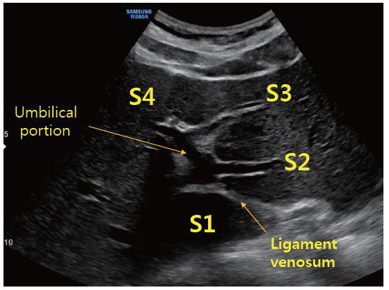 [초음파] 상복부 초음파: 표준영상 및 시행방법 - Metamedic
