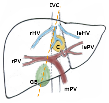 [초음파] 간(Liver): 해부학 - Metamedic