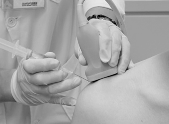 견봉쇄골관절 주사(Acromioclavicular joint injection) - Metamedic