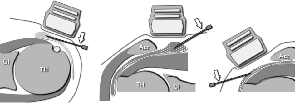 견봉삼각근하 점액낭 주사(Subacromial-subdeltoid bursa injection) - Metamedic