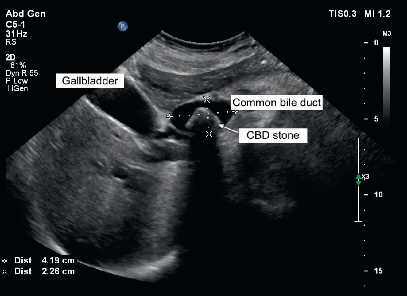 [초음파] 담낭/담도(gallbladder/bile duct): 주요 질환 (1) - Metamedic